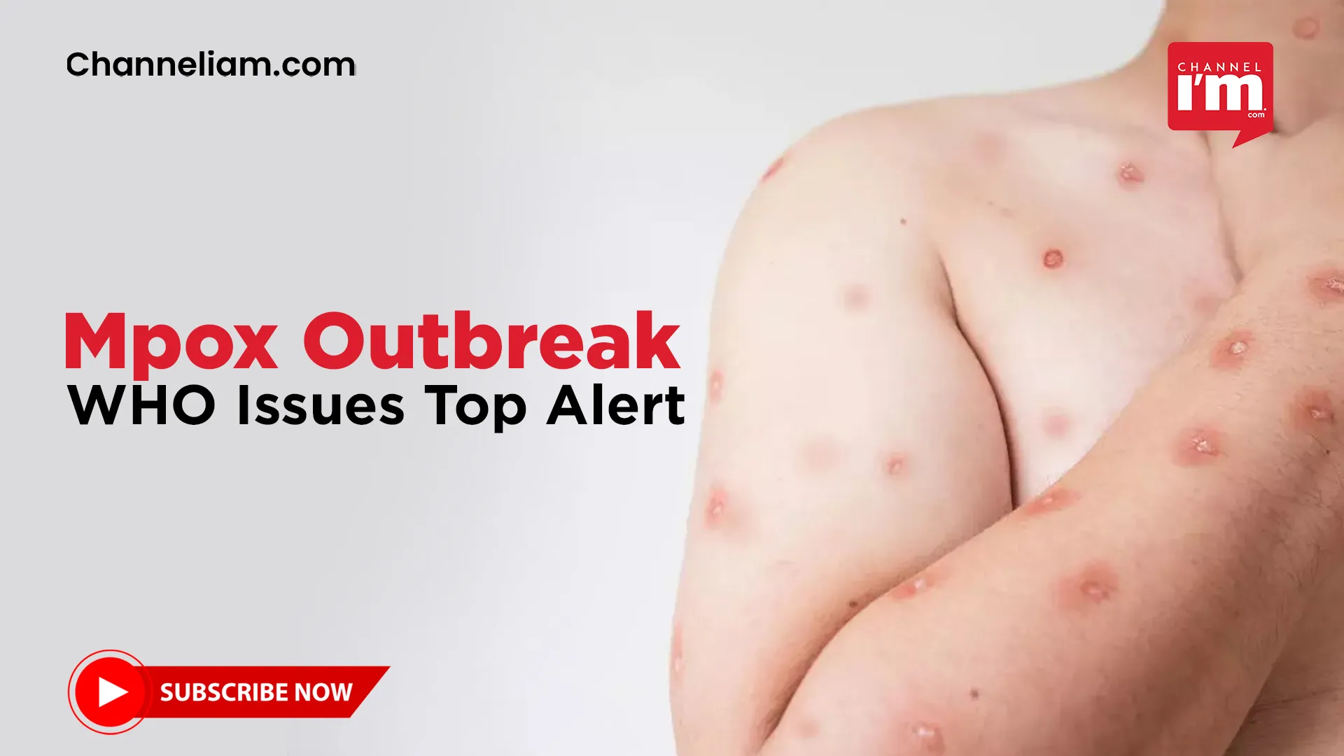 Mpox Outbreak WHO Issues Top Alert - Channeliam / Channel I'M English